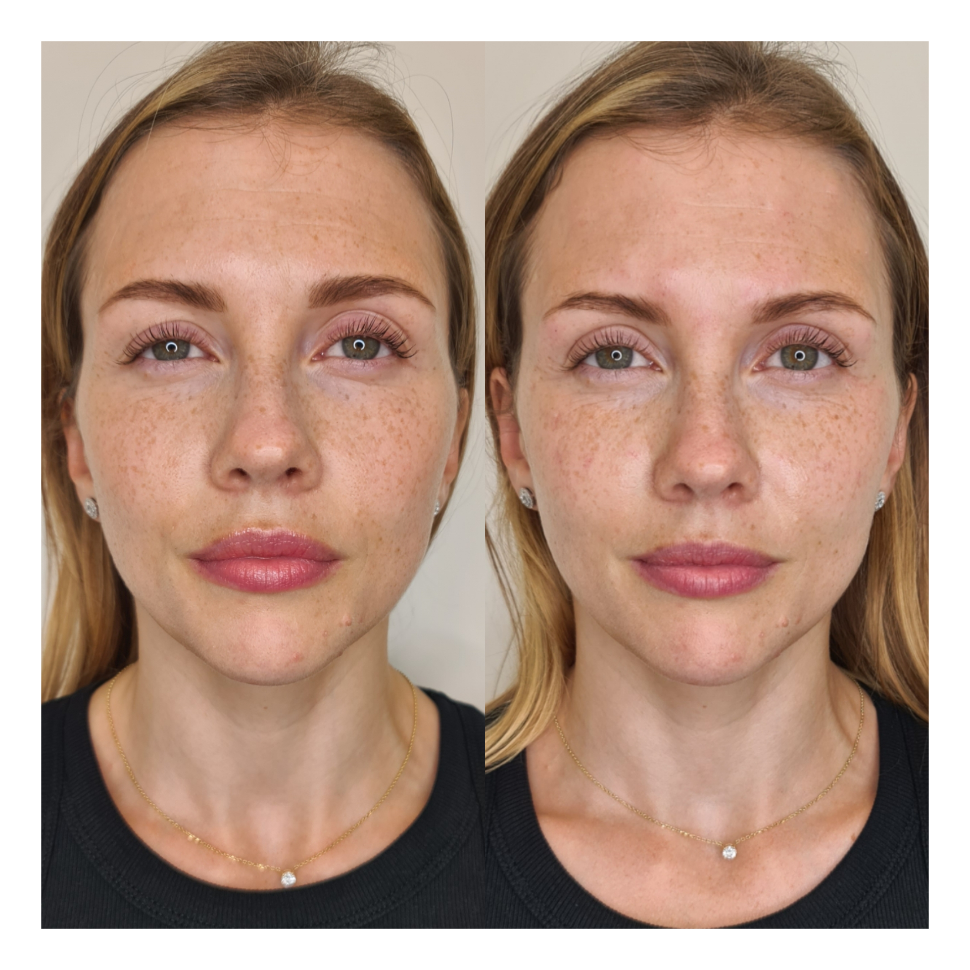 Galleri före och efter bilder